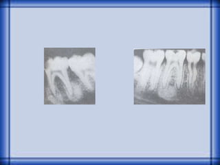 DISEASES OF DENTAL PULP AND PERI RADICULAR TISSUES.ppt