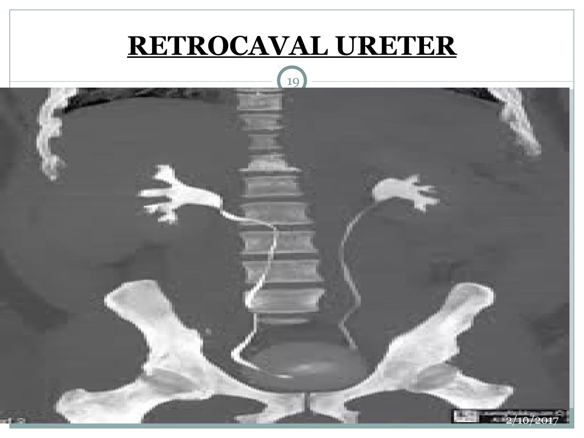 Diseases of excretory system | PPT