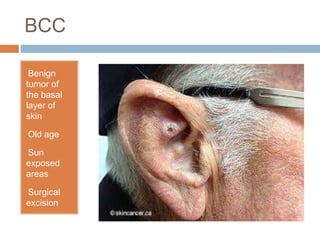Diseases of external ear | PPT