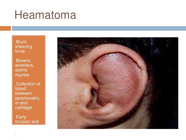 Diseases of external ear