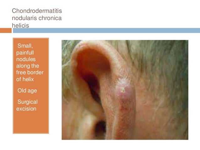 Diseases of external ear