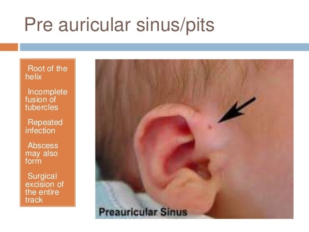 Diseases of external ear