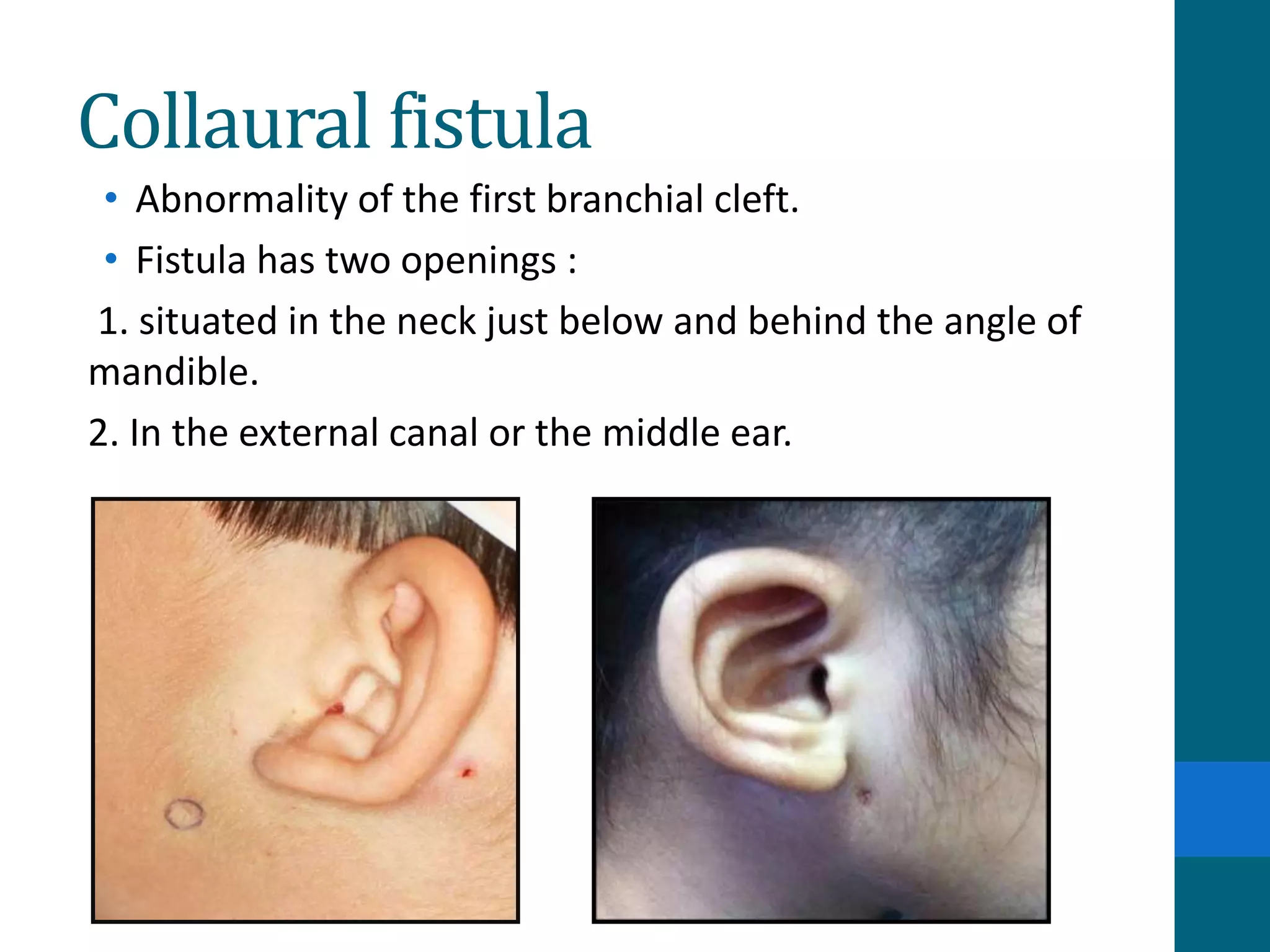 Diseases of external ear | PPTX