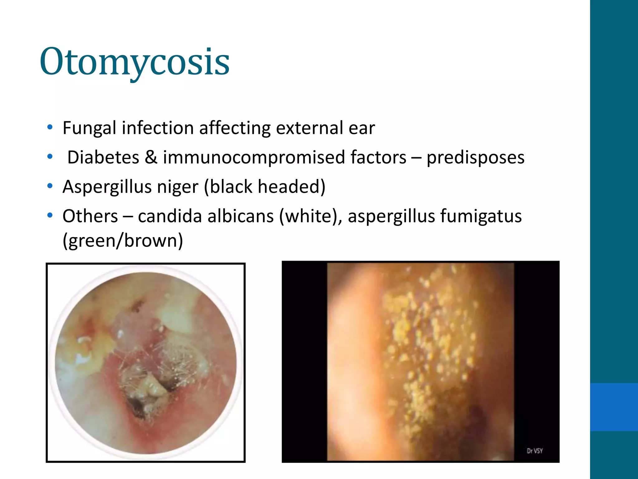 Diseases of external ear | PPTX