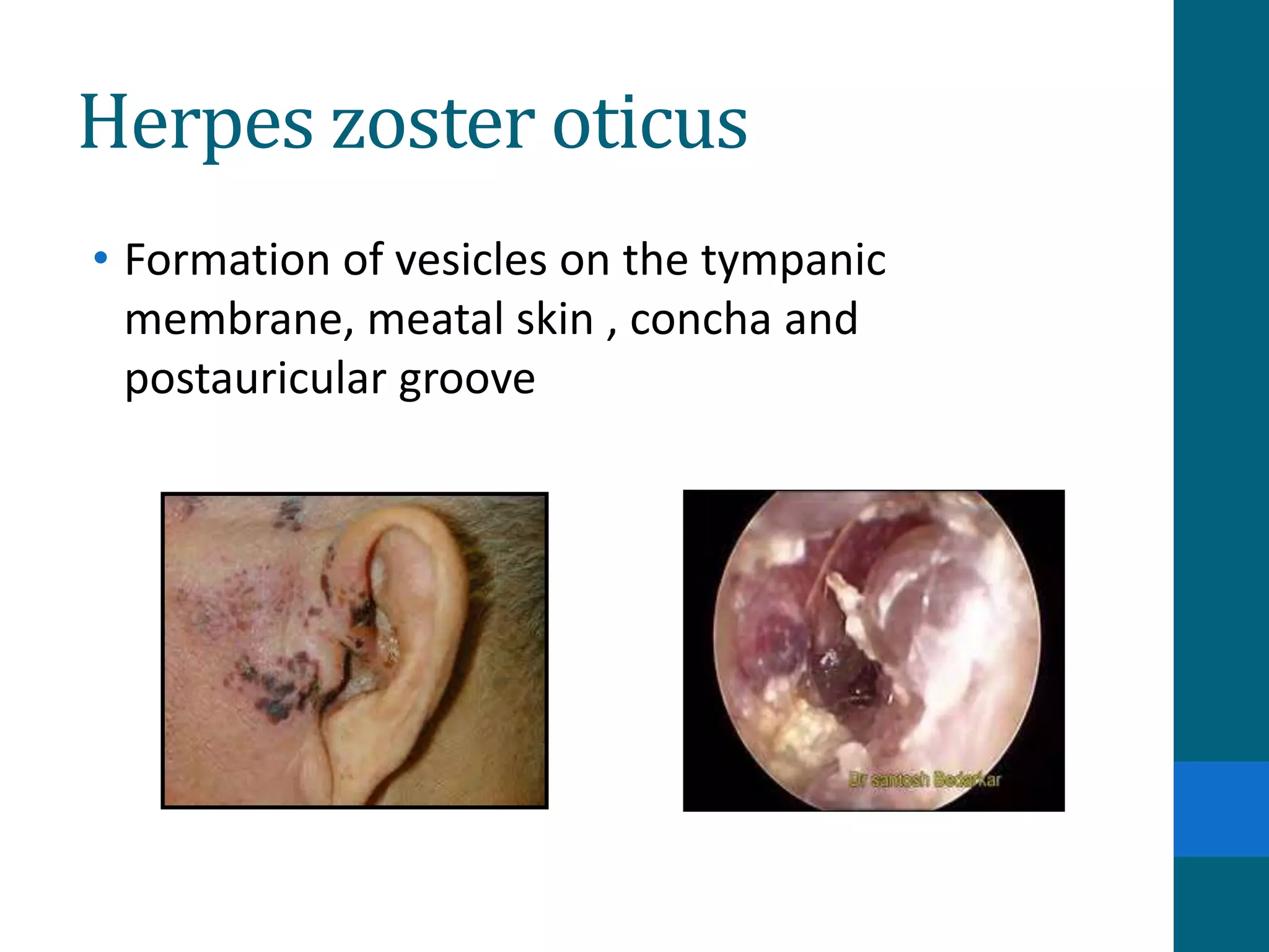 Diseases of external ear | PPTX