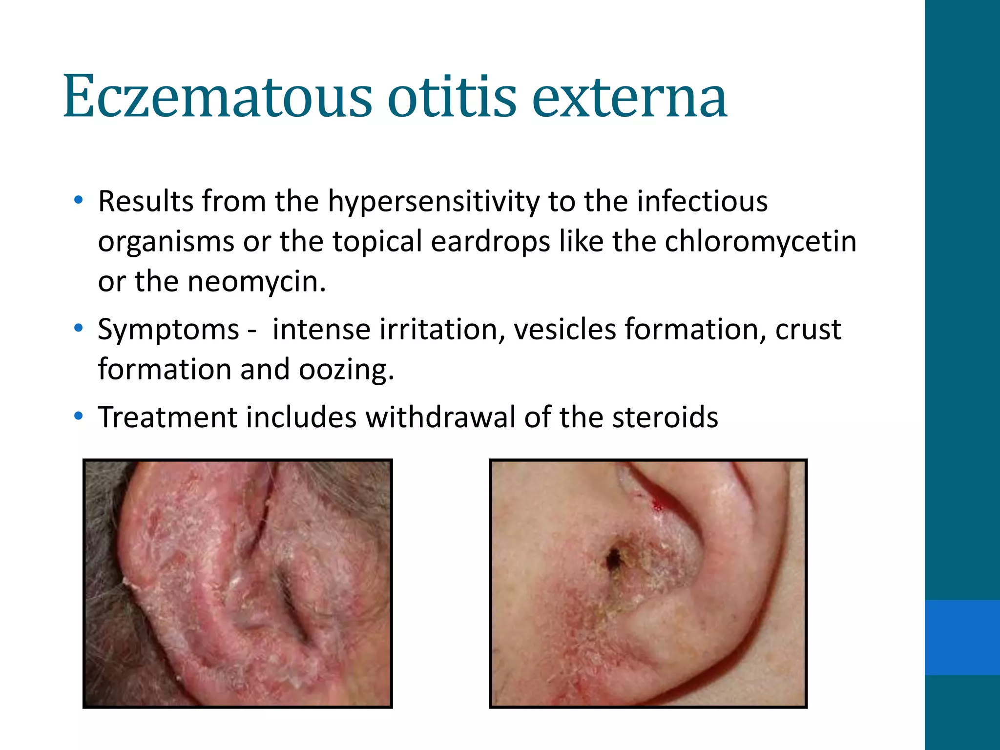 Diseases of external ear | PPTX