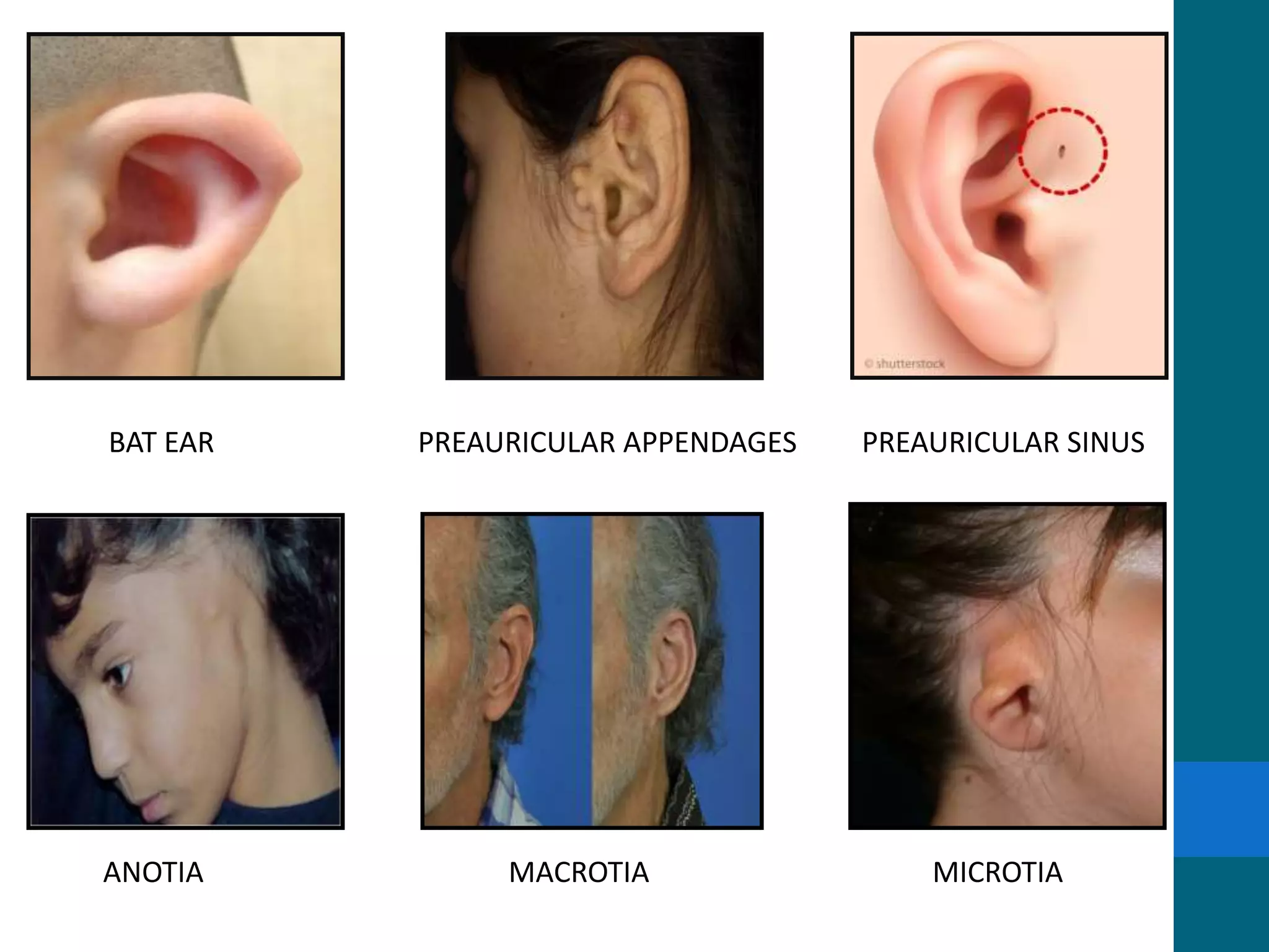 Diseases of external ear | PPTX