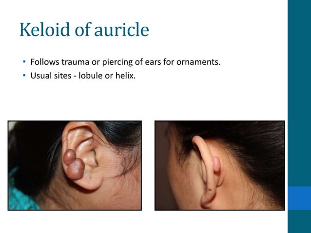 Diseases of external ear | PPTX | Ear, Nose and Throat Conditions ...