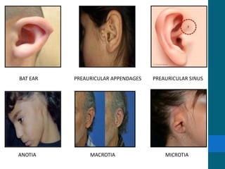 Diseases of external ear | PPTX