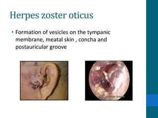 Diseases of external ear | PPT