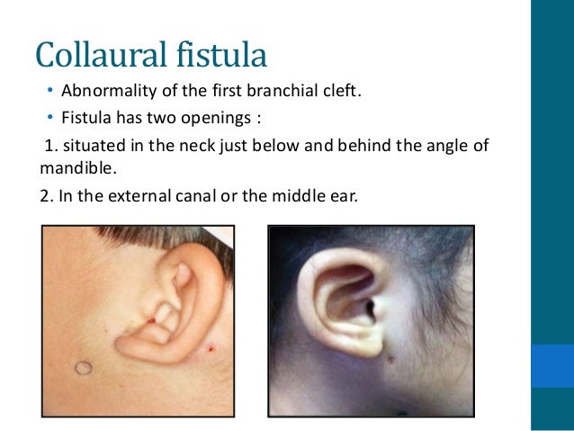 Diseases of external ear