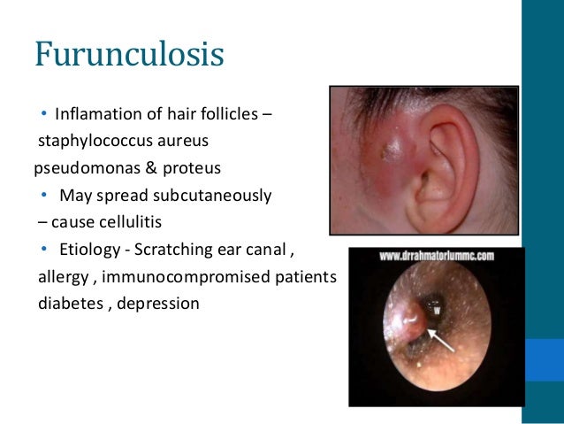 Diseases of external ear