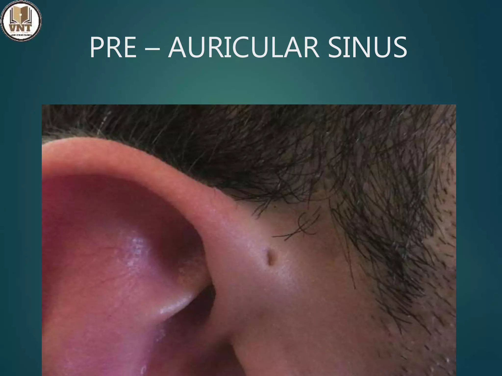 Diseases of external ear | PPTX