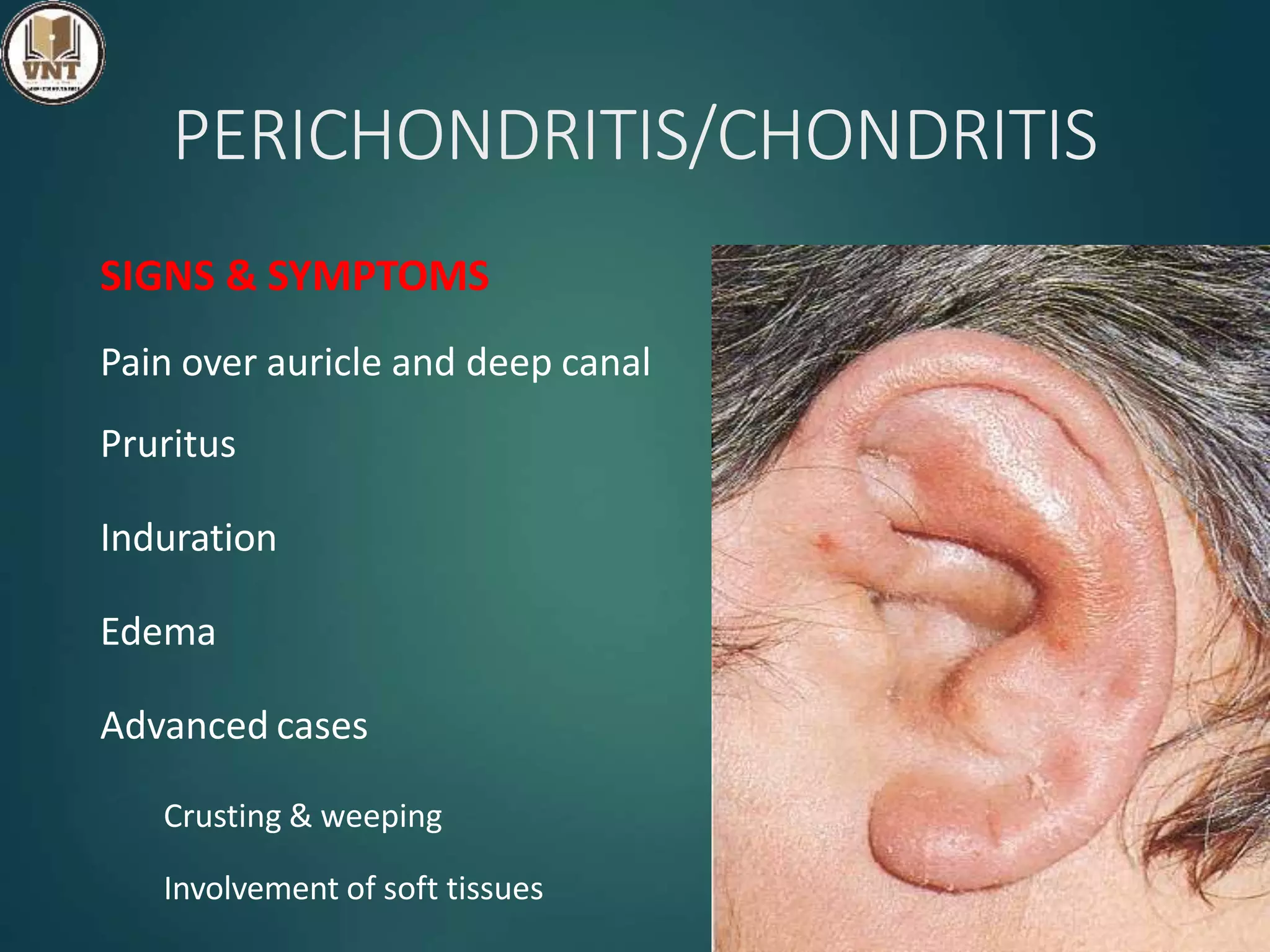 Diseases of external ear | PPTX