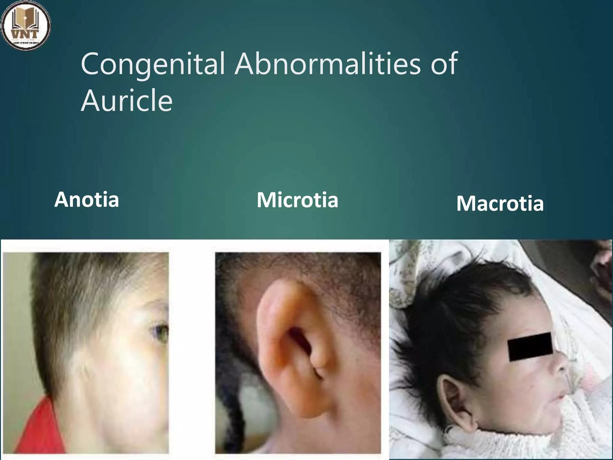 Diseases of external ear | PPTX