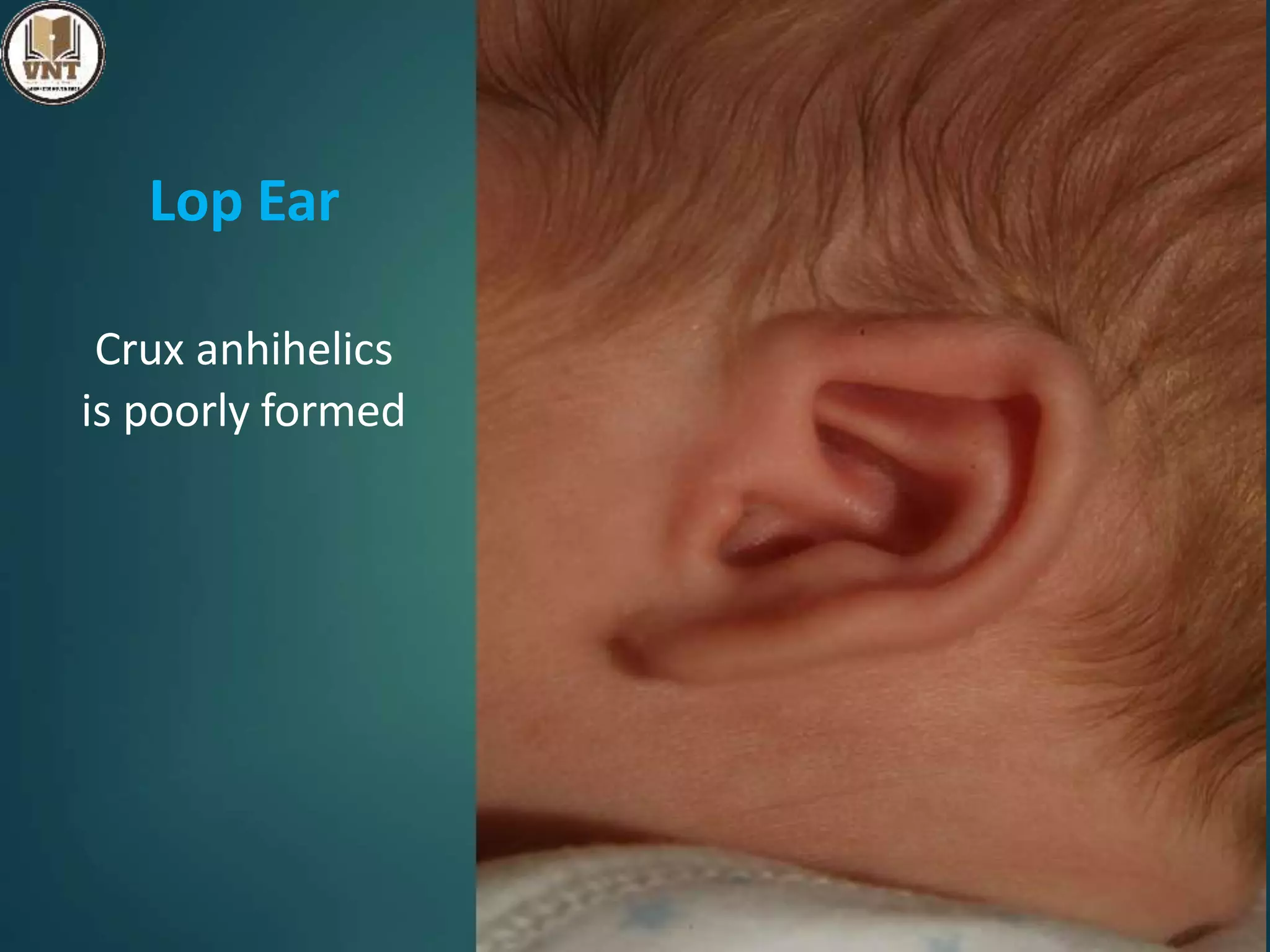 Diseases of external ear | PPTX