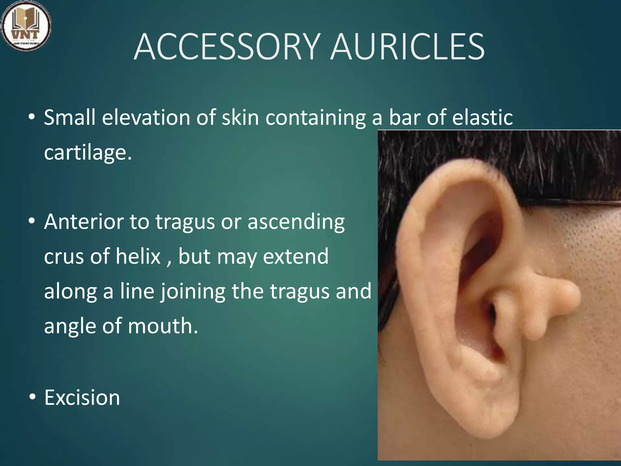 Diseases of external ear | PPTX