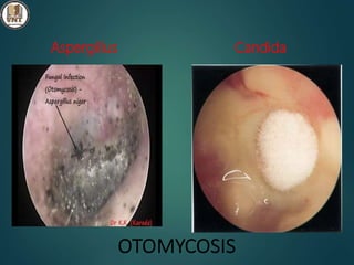 Diseases of external ear | PPTX