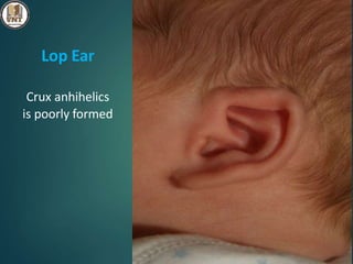 Diseases of external ear | PPTX