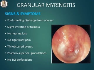 Granular Myringitis