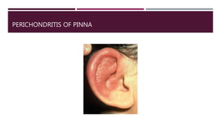 Diseases of external ear Dr Utkal Mishra | PPTX