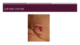Diseases of external ear Dr Utkal Mishra | PPTX