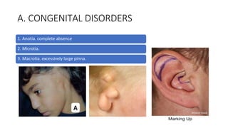 diseasesofexternalear | PPT