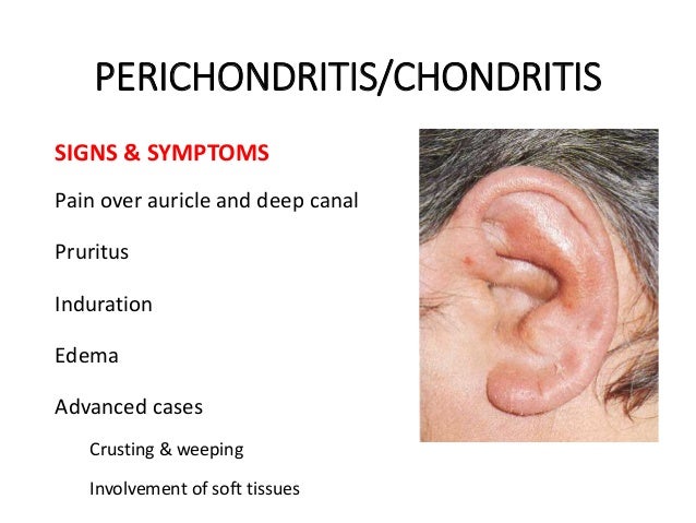 External Ear Cellulitis