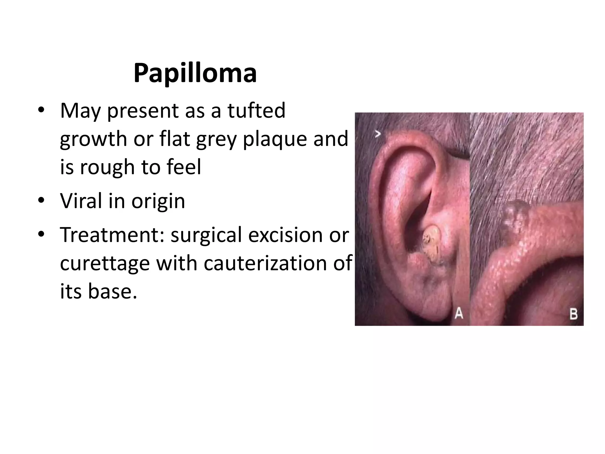 Diseases of external ear and its management | PPTX