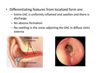 Diffuse Otitis Externa