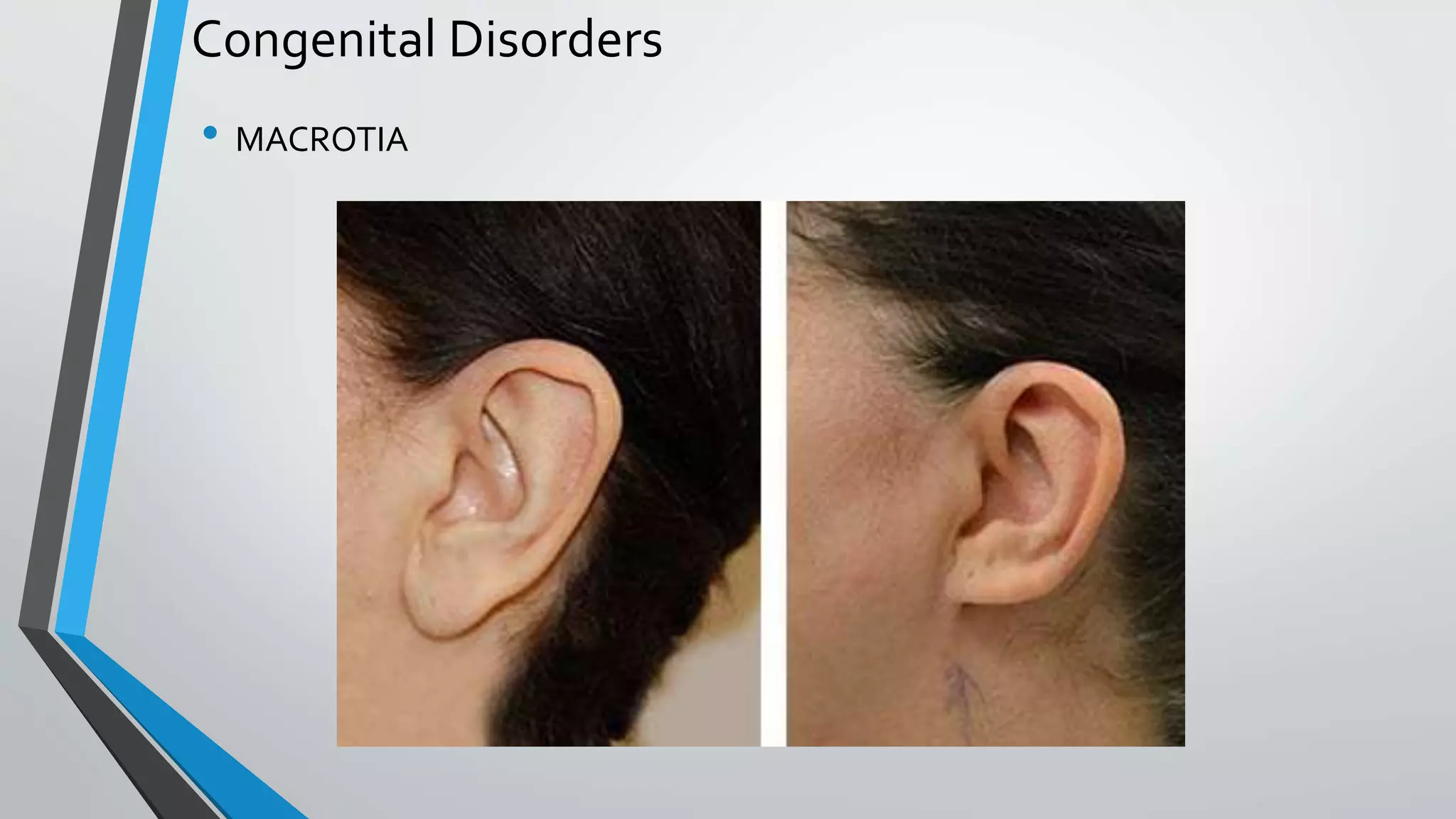 Diseases of External Ear.pptx