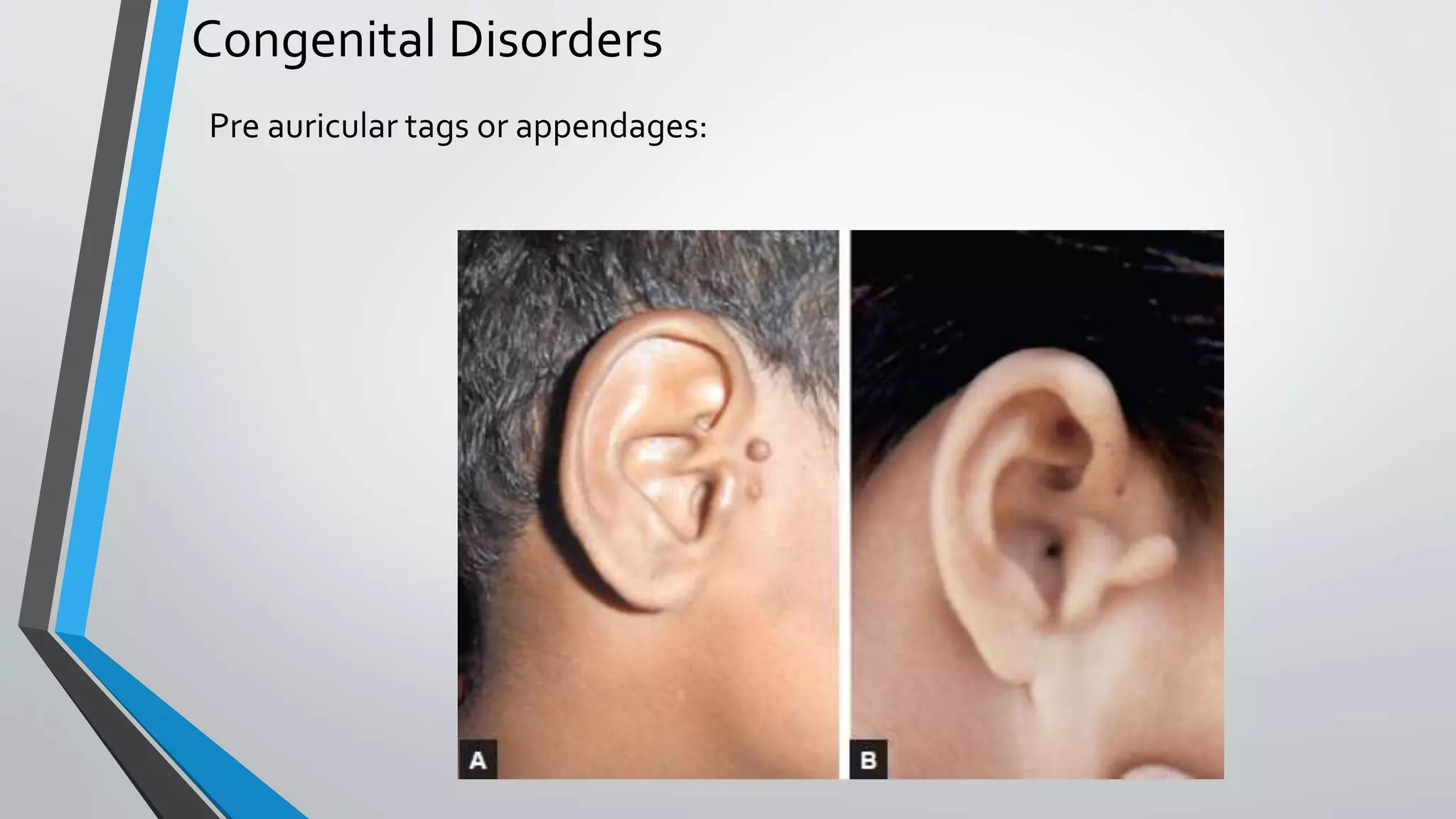 Diseases of External Ear.pptx