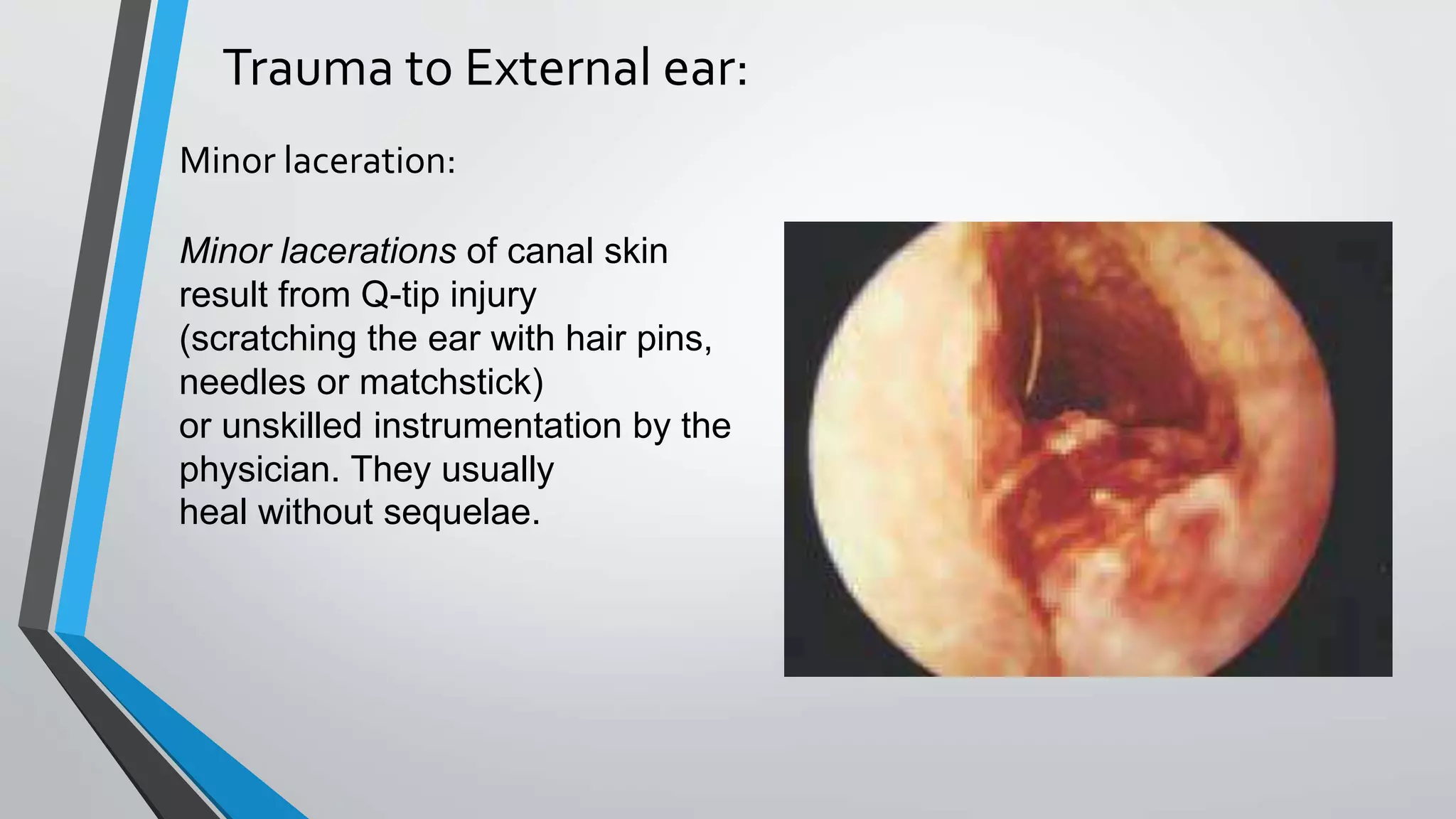 Diseases of External Ear.pptx