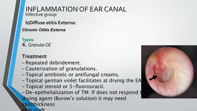 Diseases of External Ear.pptx | Ear, Nose and Throat Conditions ...