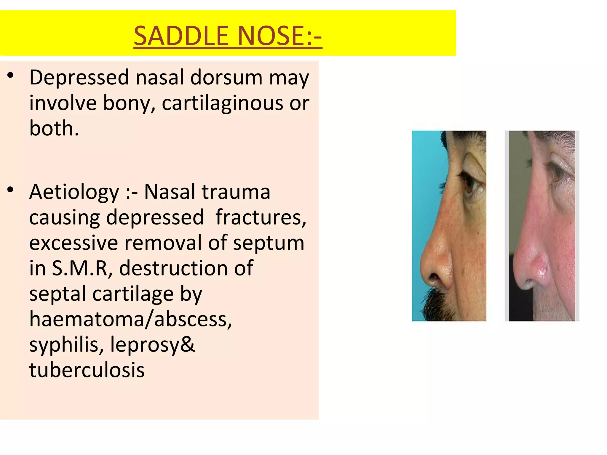 DISEASES OF EXTERNAL NOSE AND VESTIBULE BY DR.SYED REHMATHULLAH | PPT