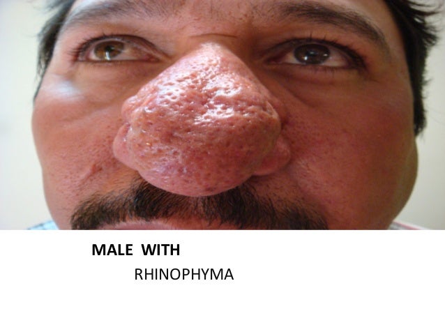 DISEASES OF EXTERNAL NOSE AND VESTIBULE BY DR.SYED REHMATHULLAH