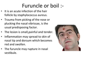 Inside Nasal Wall Boil