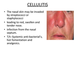 Cellulitis Nostril