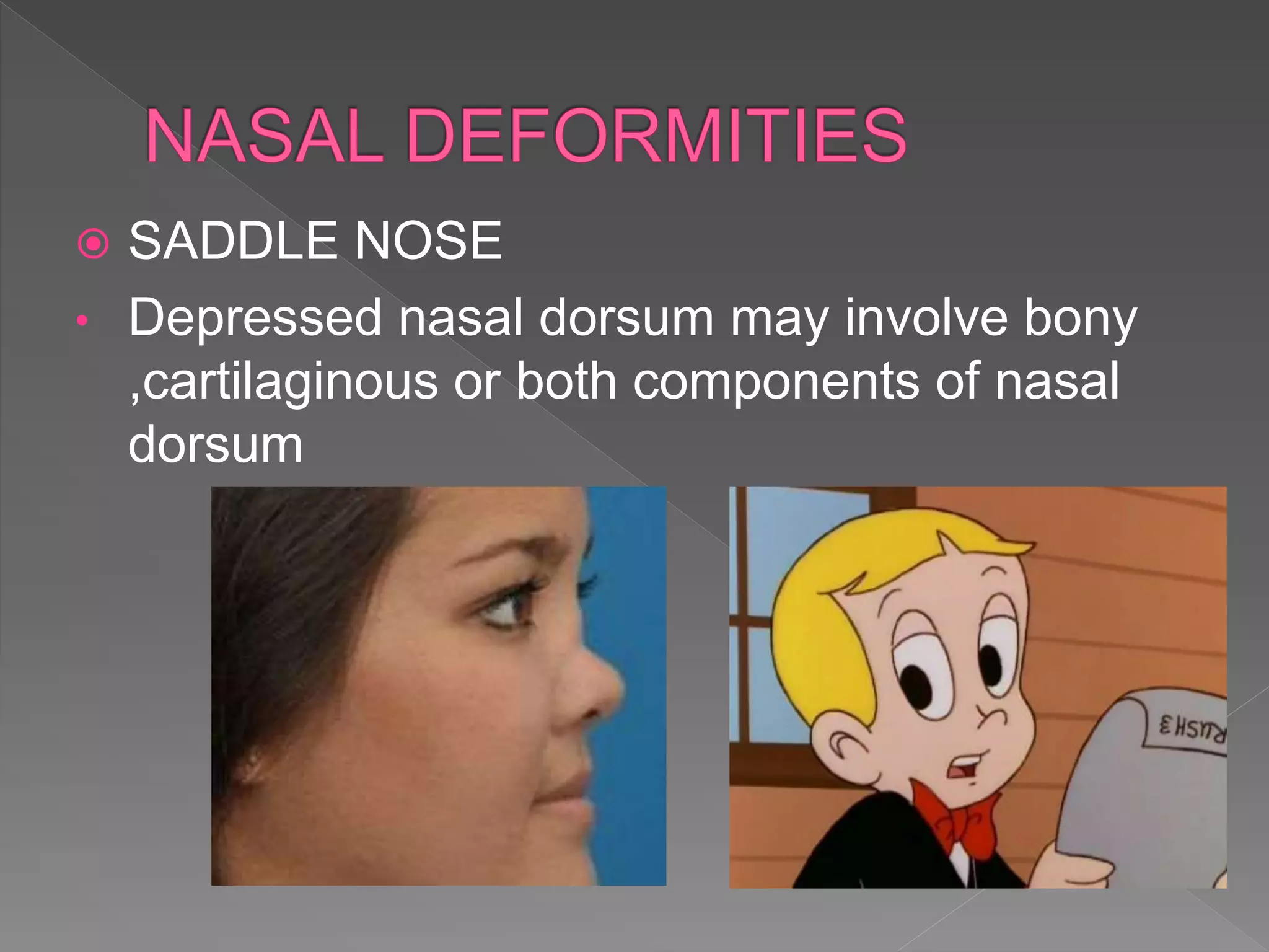 Diseases of external nose | PPTX