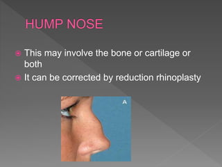 Diseases of external nose | PPTX