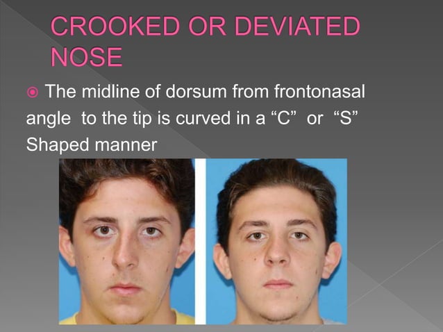 Diseases of external nose | PPTX