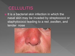 Diseases of external nose | PPTX