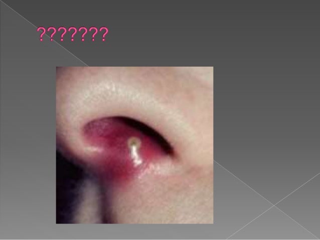 Diseases of external nose