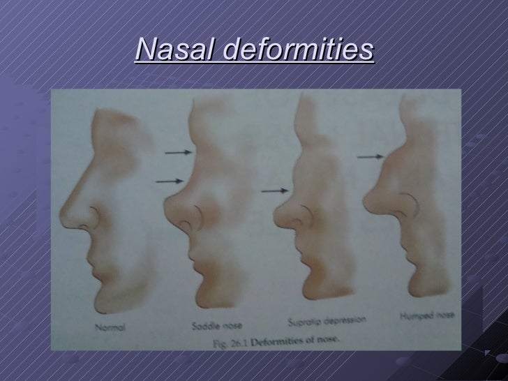 Diseases of external nose and vestibule