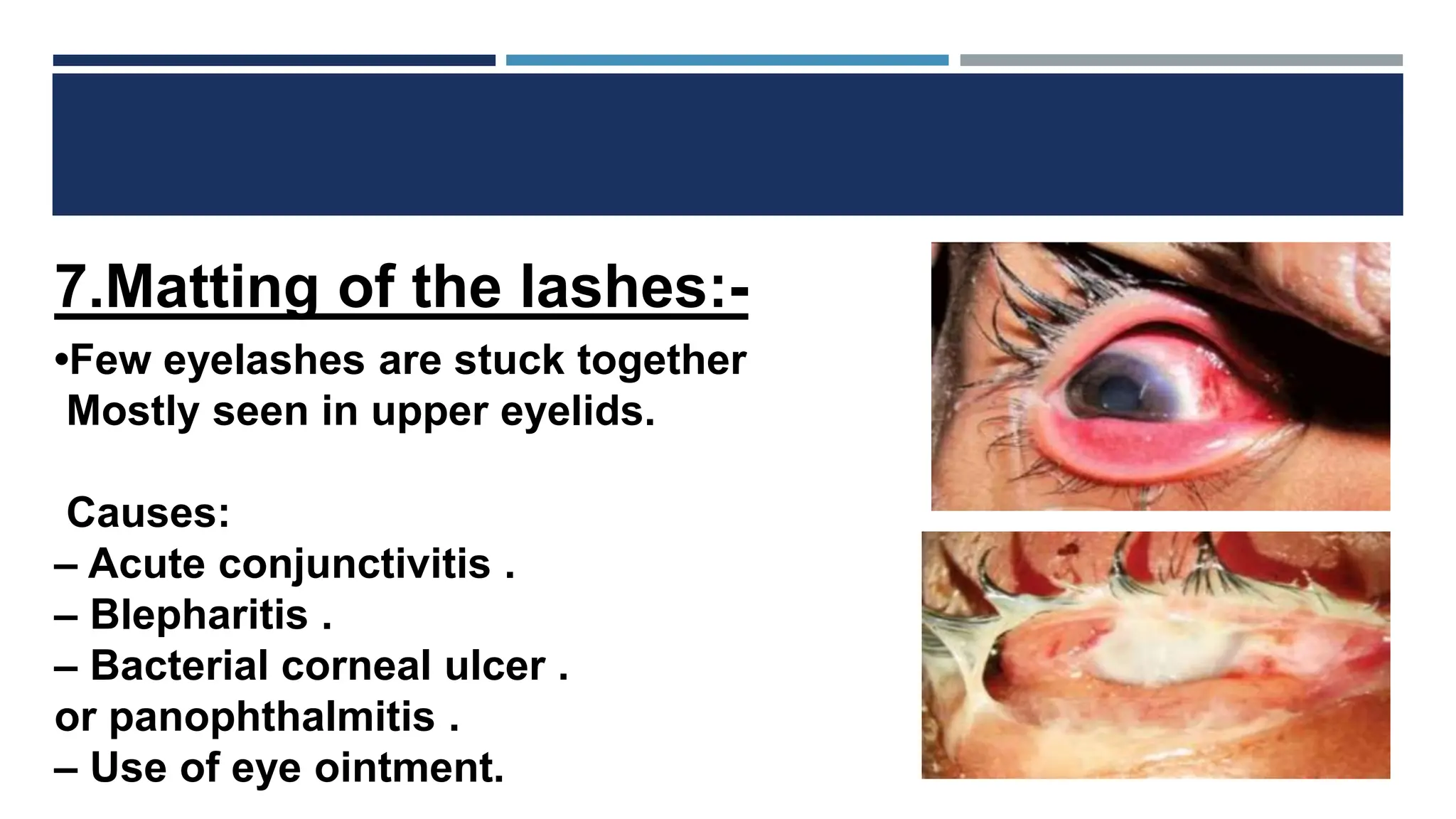 Diseases of eyelids like Epicanthus, entropian, ectropian, Telecanthus ...