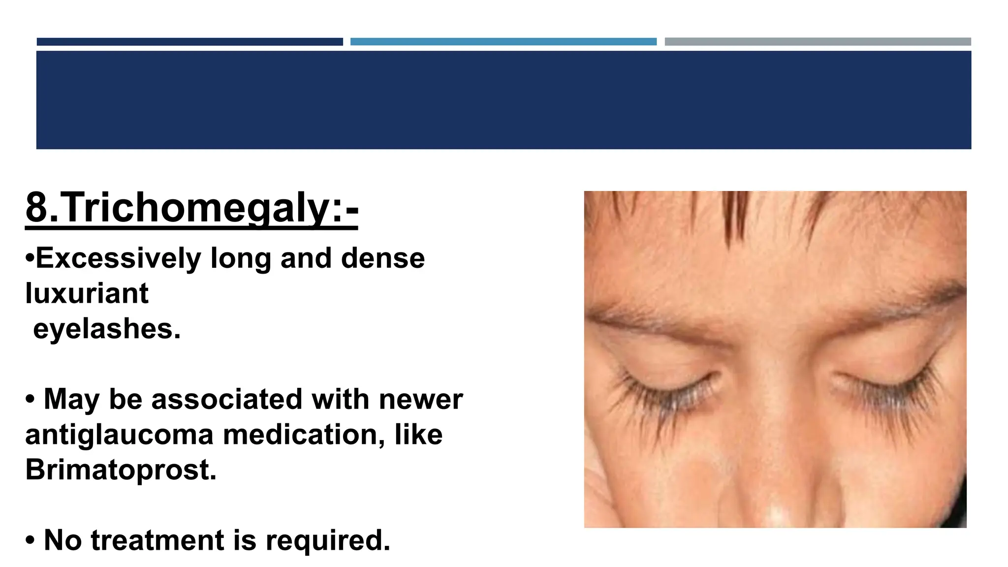 Diseases of eyelids like Epicanthus, entropian, ectropian, Telecanthus ...