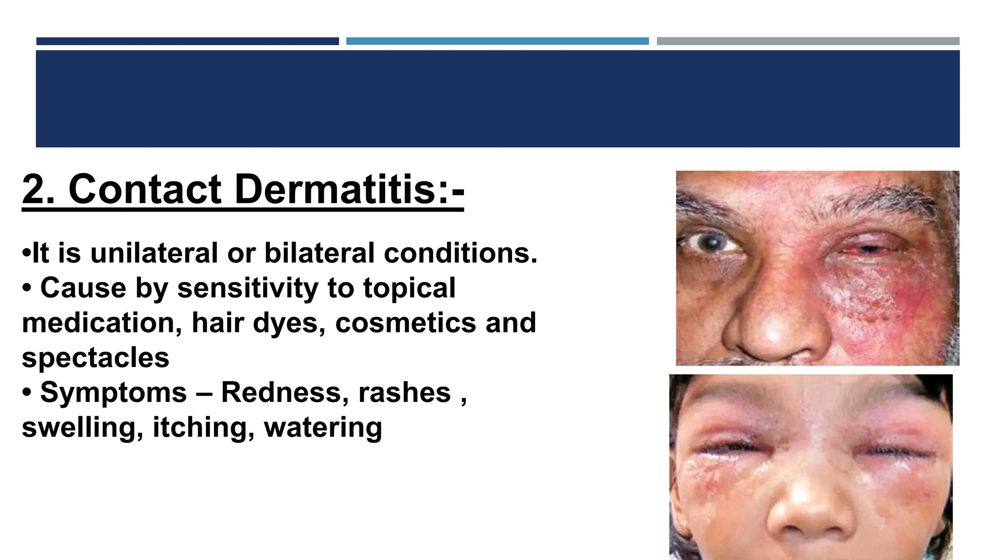 Diseases of eyelids like Epicanthus, entropian, ectropian, Telecanthus ...