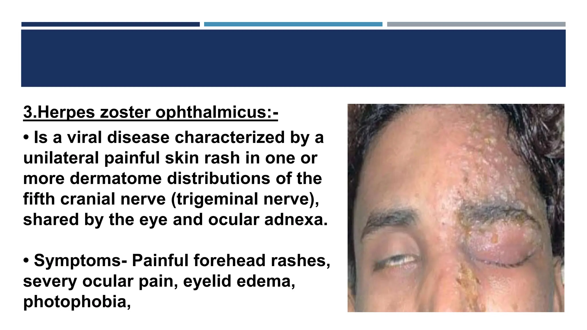 Diseases of eyelids like Epicanthus, entropian, ectropian, Telecanthus ...