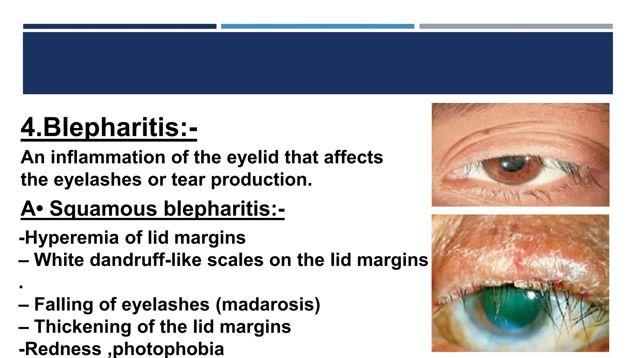 Diseases of eyelids like Epicanthus, entropian, ectropian, Telecanthus ...