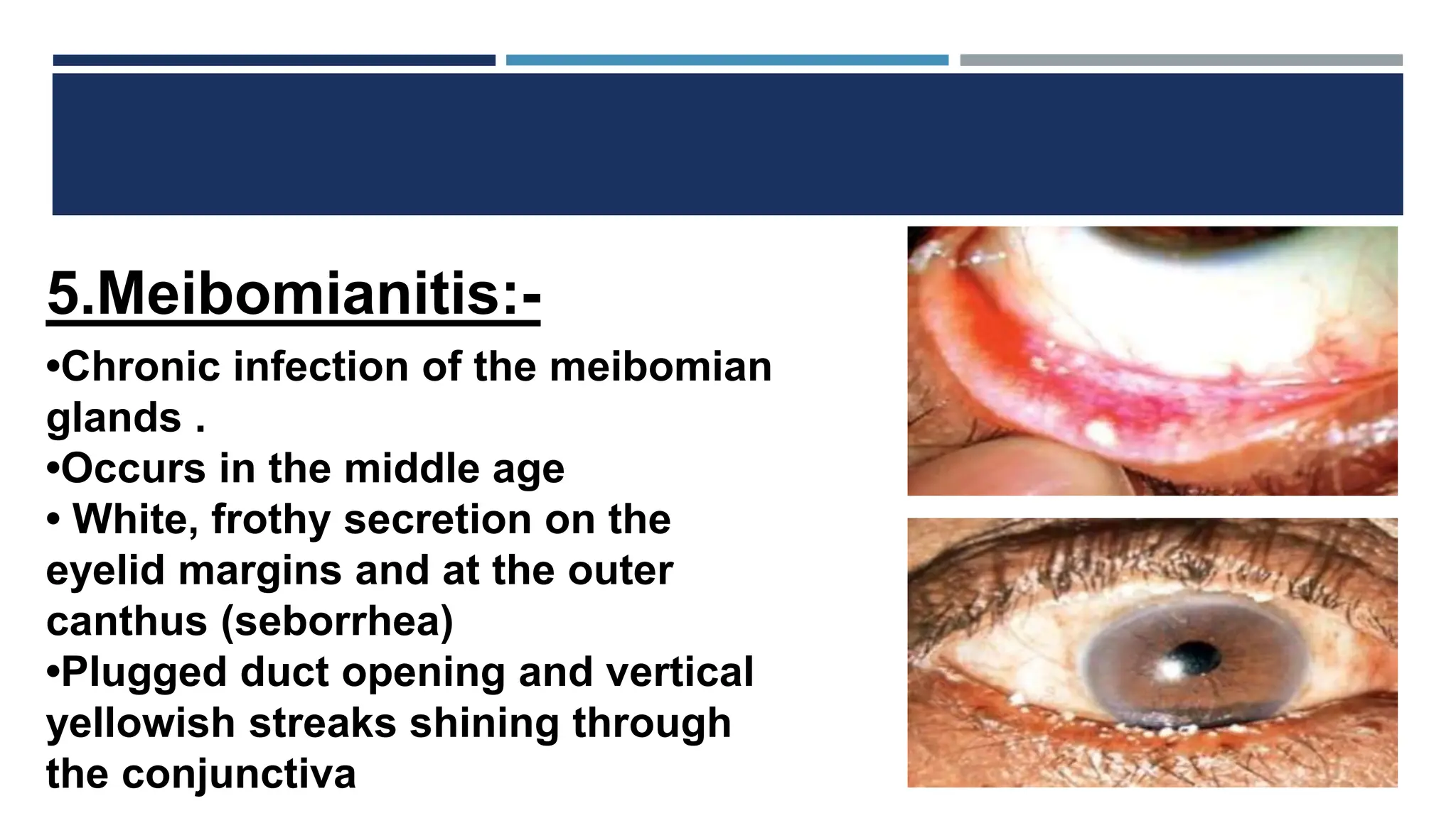 Diseases of eyelids like Epicanthus, entropian, ectropian, Telecanthus ...